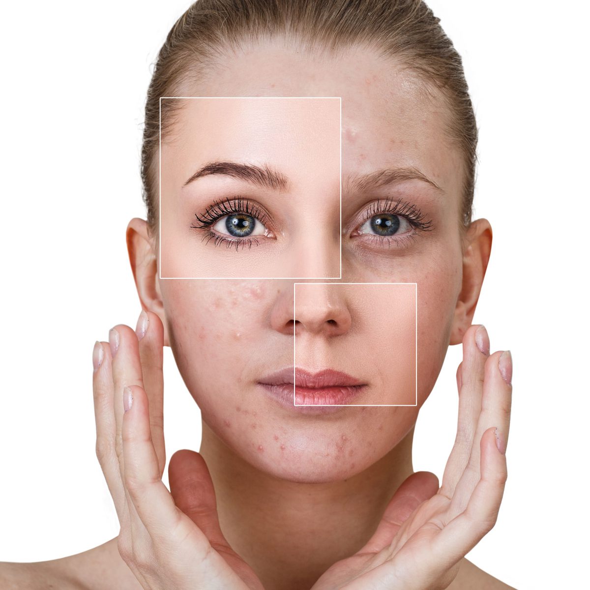 Acne Treatment | Improve Your Skin Aesthetics | Oswestry